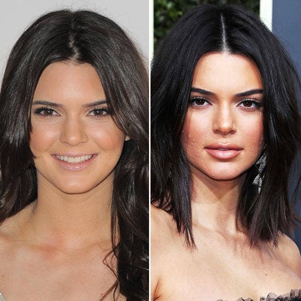 Did Kendall Jenner Get Lip Injections Before And After Photos Golden 2363